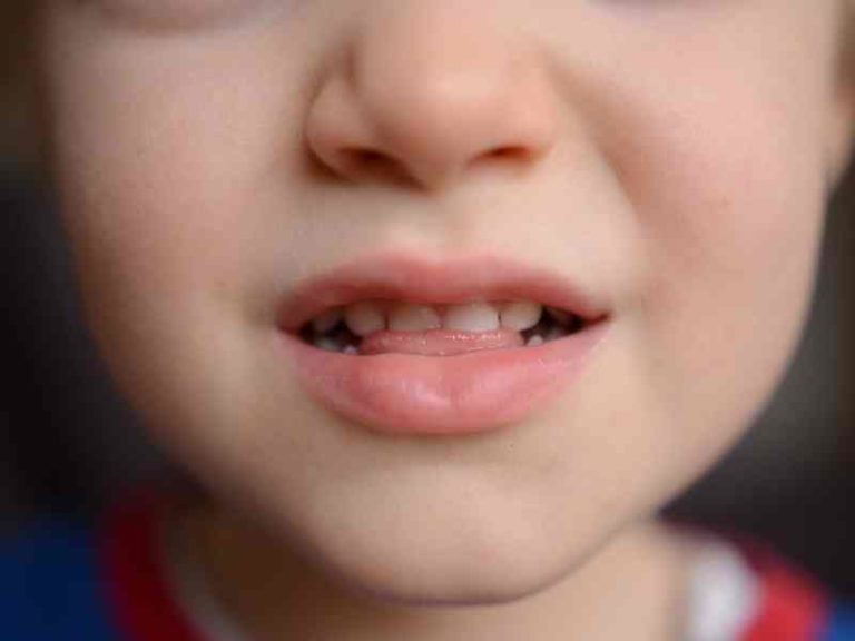 Paukenerguss und Polypen: So beeinflussen sie die Sprachentwicklung ...