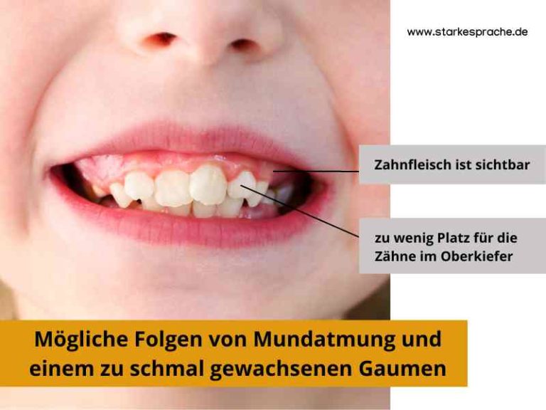 Mundatmung bei Kindern: 5 Gründe, warum dein Kind nicht durch den Mund ...
