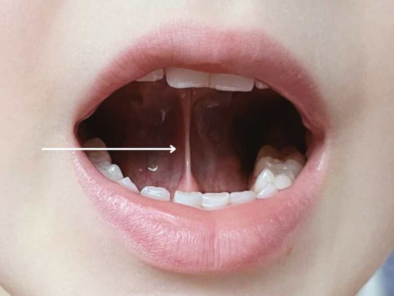 Hat mein Kind ein zu kurzes Zungenband? - starke sprache