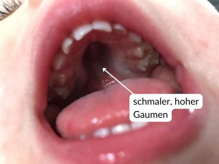 Was ist die Zungenruhelage und wie kann ich sie meinem Kind zeigen ...